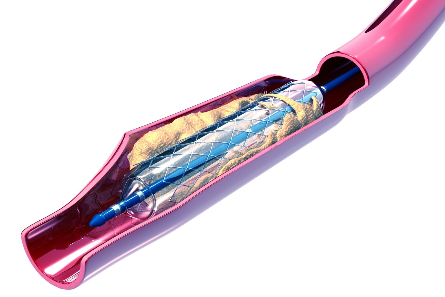 Eliminating PFAS Concerns in Balloon Catheter Manufacturing with ...